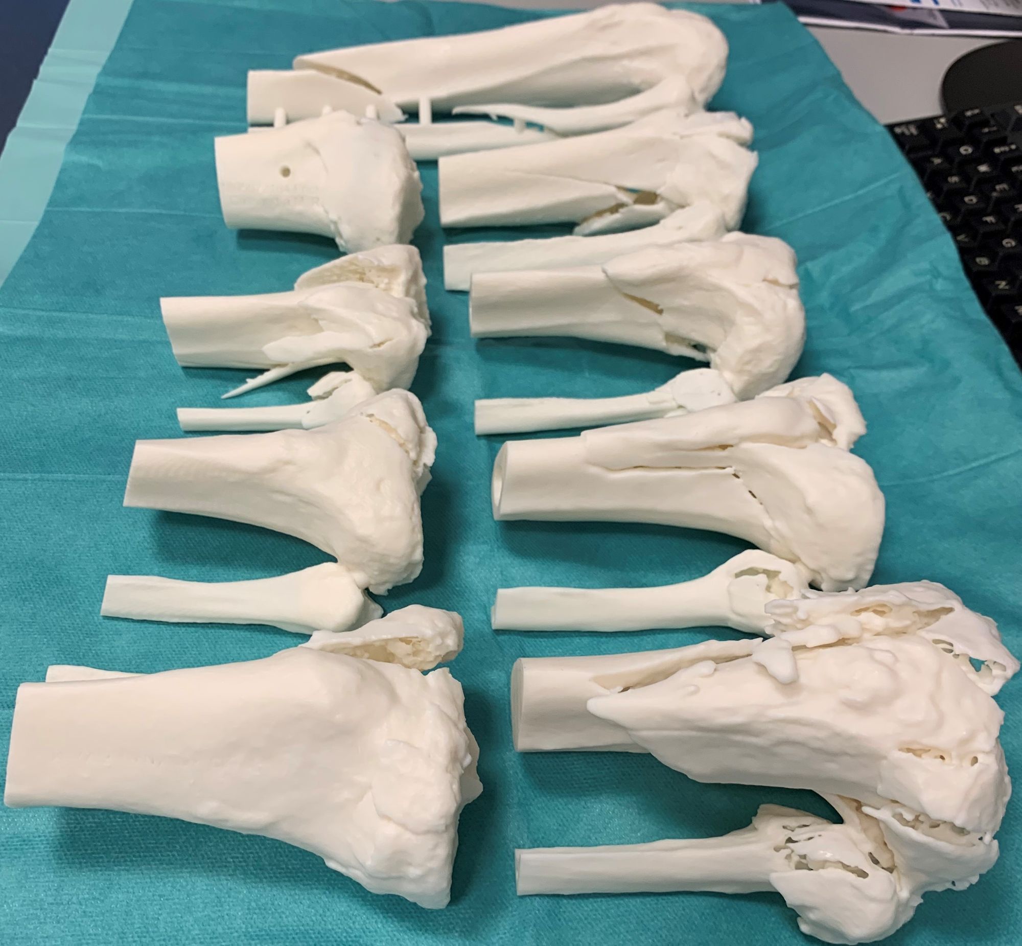 The Effect of 3D-Printing Proximal Tibia Fractures in Preoperative Planning
